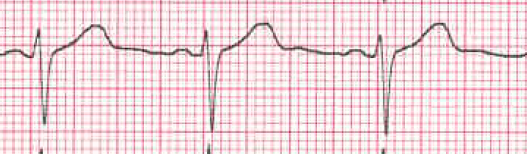 Onde U — uness wiki ecg