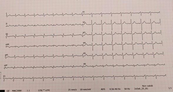 ECG et embolie pulmonaire — uness wiki ecg