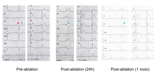 Anomalie de la repolarisation: généralités — uness wiki ecg