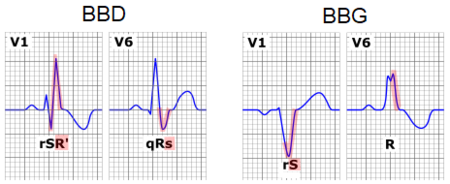 Bloc de branche: généralités — uness wiki ecg