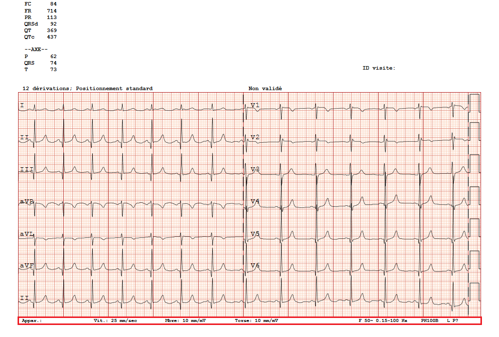 ECG réalisation — Uness Cardiologie