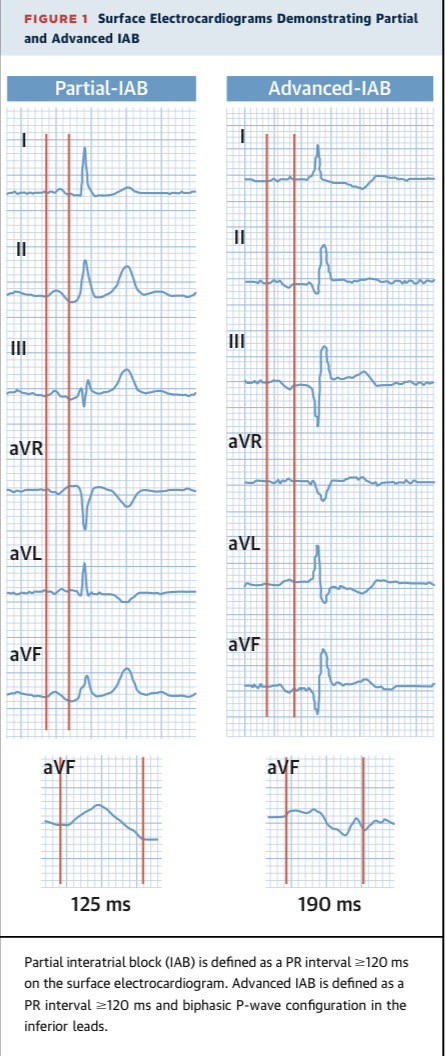 Blocs de conduction: Généralités — Uness Cardiologie