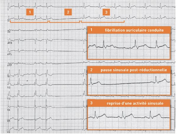 Dysfonction sinusale / bloc sino-atrial — Uness Cardiologie
