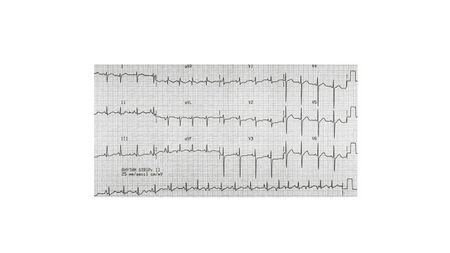 Extrasystole atriale — Uness Cardiologie