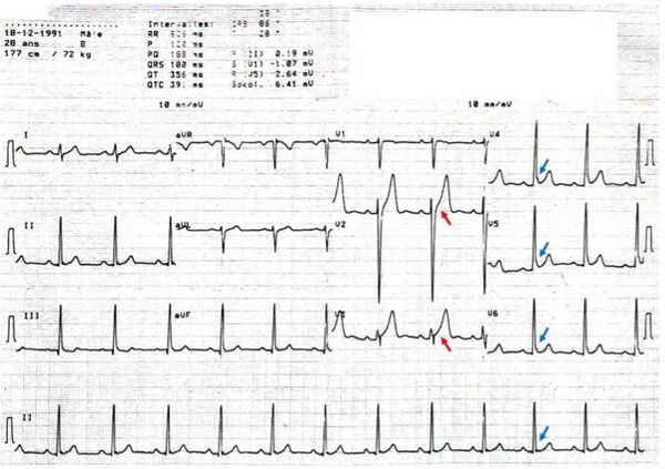 Spécificité de l'ECG selon l'origine ethnique — Uness Cardiologie