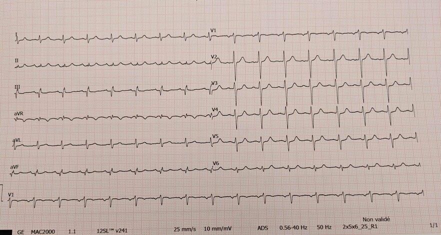 ECG et embolie pulmonaire — Uness Cardiologie