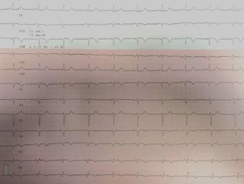 Onde Q — Uness Cardiologie