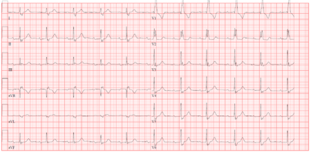 Bloc de branche droit — Uness Cardiologie