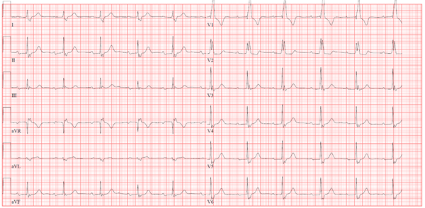 Bloc de branche droit — Uness Cardiologie