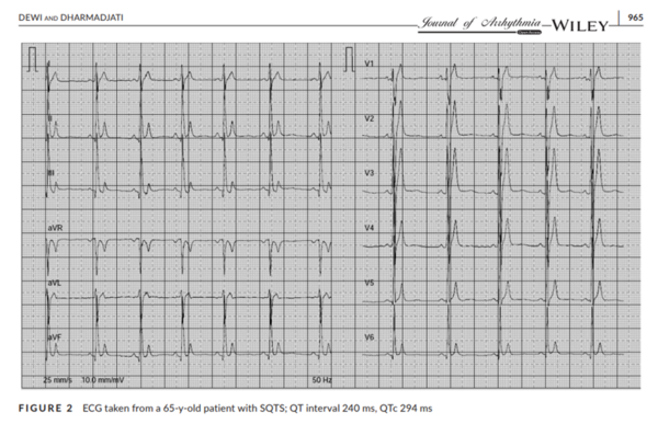 Syndrome du QT court congénital — Uness Cardiologie