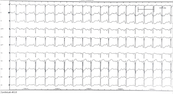 Repolarisation atriale — Uness Cardiologie