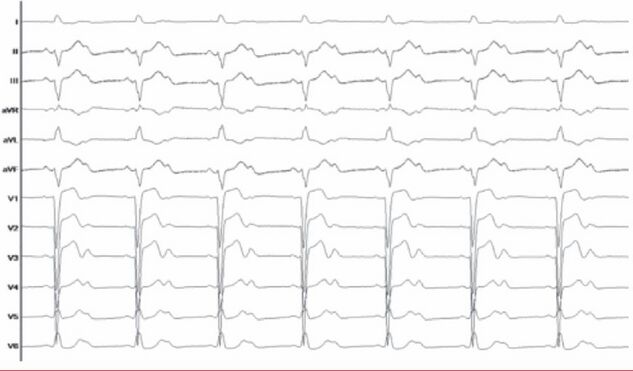 Bloc AV 2e degré Bloc 2/1 — Uness Cardiologie