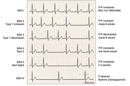 Dysfonction sinusale / bloc sino-atrial — Uness Cardiologie