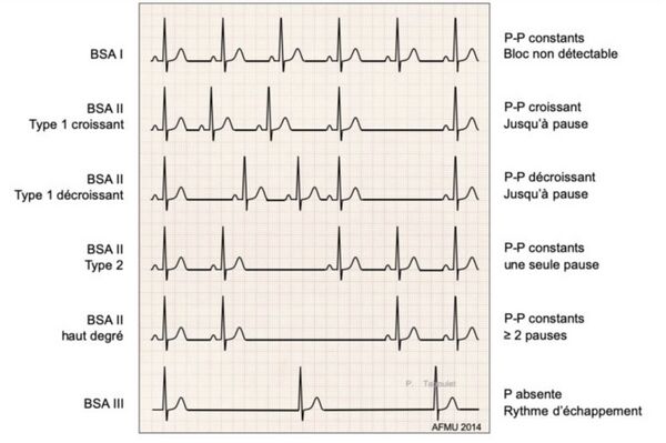 Dysfonction sinusale / bloc sino-atrial — Uness Cardiologie