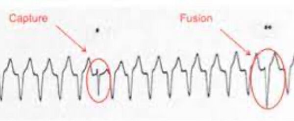 Tachycardies à QRS larges (TSV ou TV) — Uness Cardiologie