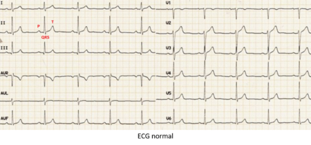 Rythme sinusal — Uness Cardiologie
