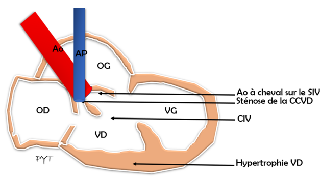 ECG de Tétralogie de Fallot — Uness Cardiologie