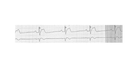 Extrasystole atriale — Uness Cardiologie