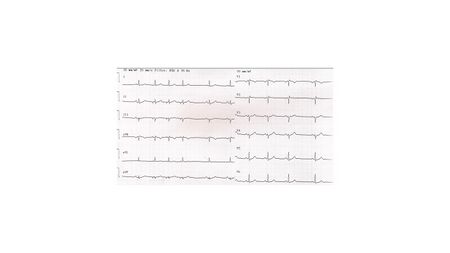 Extrasystole atriale — Uness Cardiologie