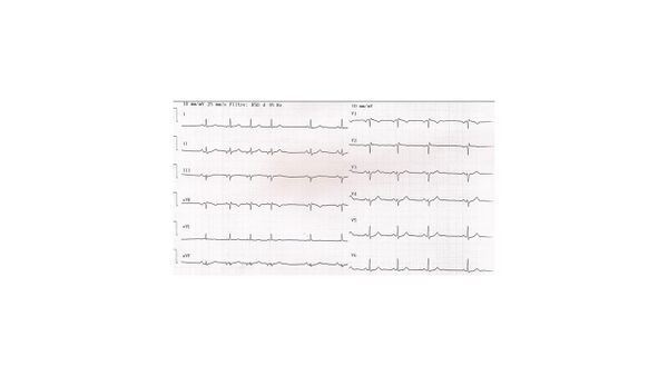 Extrasystole atriale — Uness Cardiologie
