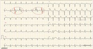 Blocs de conduction: Généralités — Uness Cardiologie