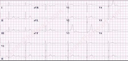 Bloc AV 2e degré Bloc 2/1 — Uness Cardiologie