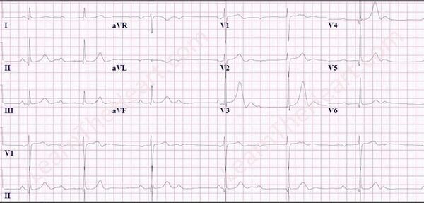 Bloc AV 2e degré Bloc 2/1 — Uness Cardiologie