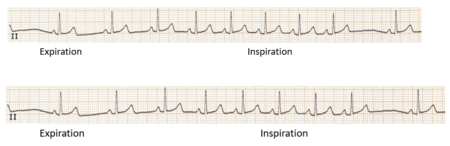 Rythme sinusal — Uness Cardiologie