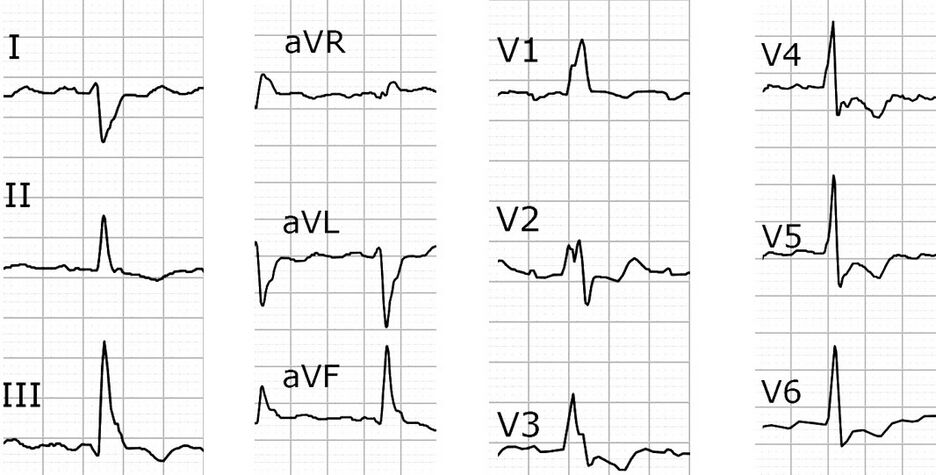 ECG de Tétralogie de Fallot — Uness Cardiologie