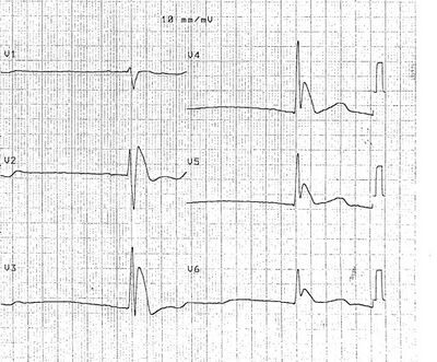 ECG et Hypothermie — Uness Cardiologie