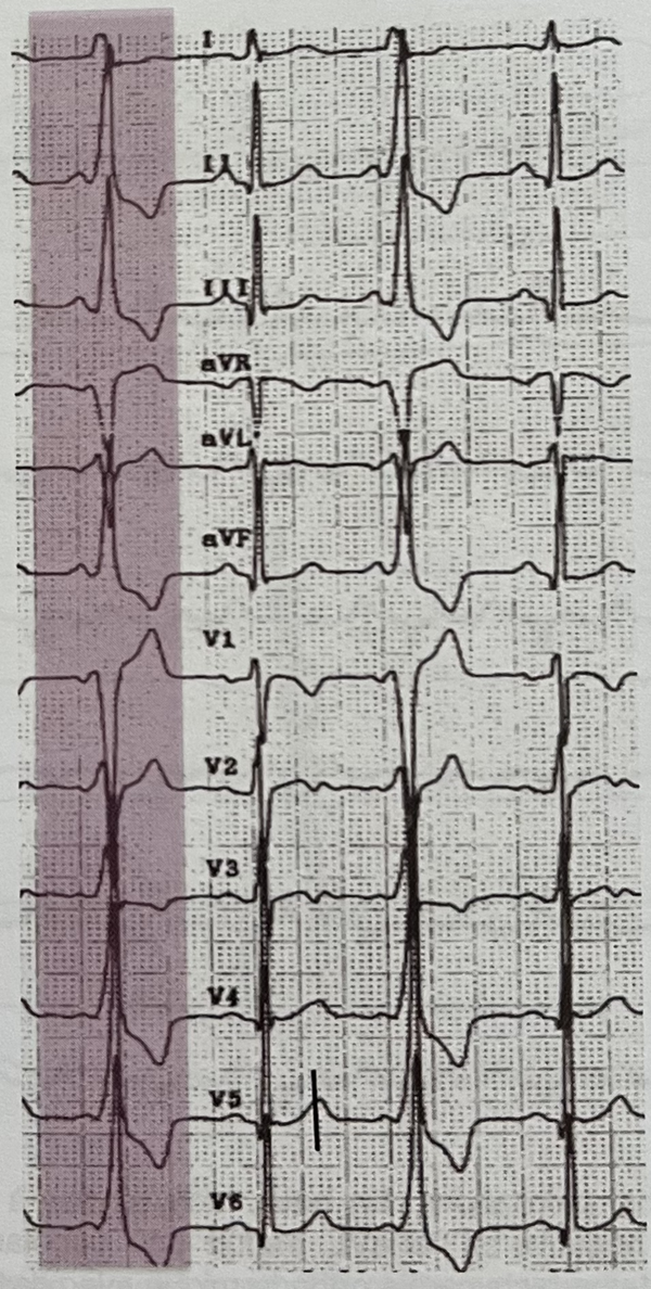 Onde delta — Uness Cardiologie