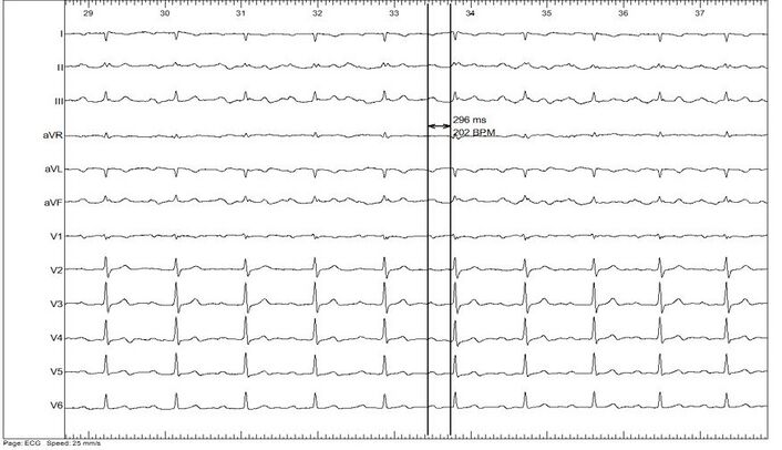 Bloc AV 1er degré — Uness Cardiologie