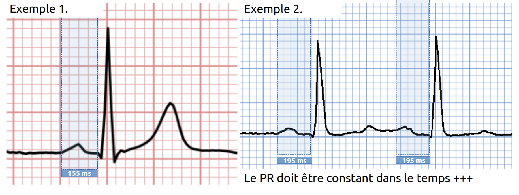 Electrocardiogramme normal — Uness Cardiologie