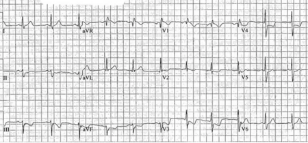 Infarctus et BBD — Uness Cardiologie
