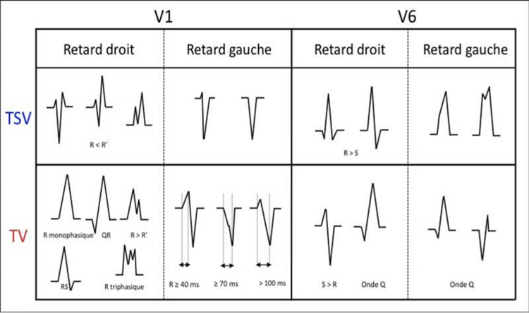 Discrimination TSV / TV (ECG) — Uness Cardiologie
