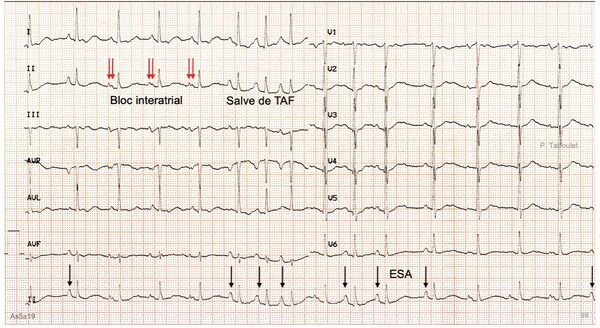 Blocs de conduction: Généralités — Uness Cardiologie