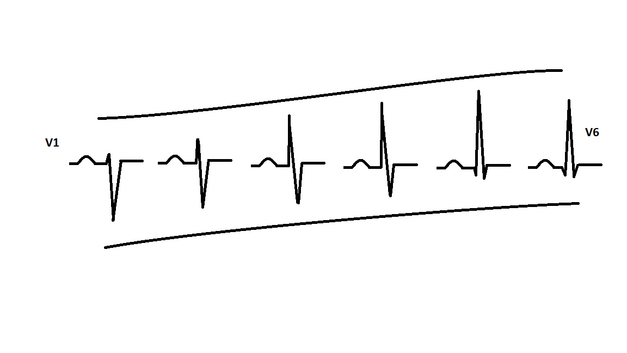 Onde S — Uness Cardiologie