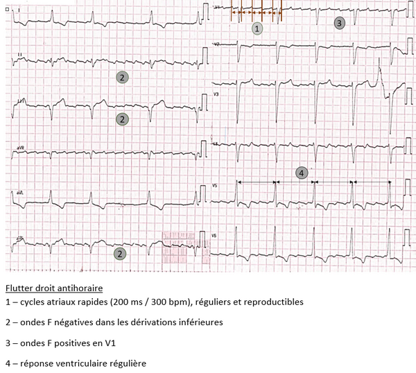 Flutter atrial — Uness Cardiologie