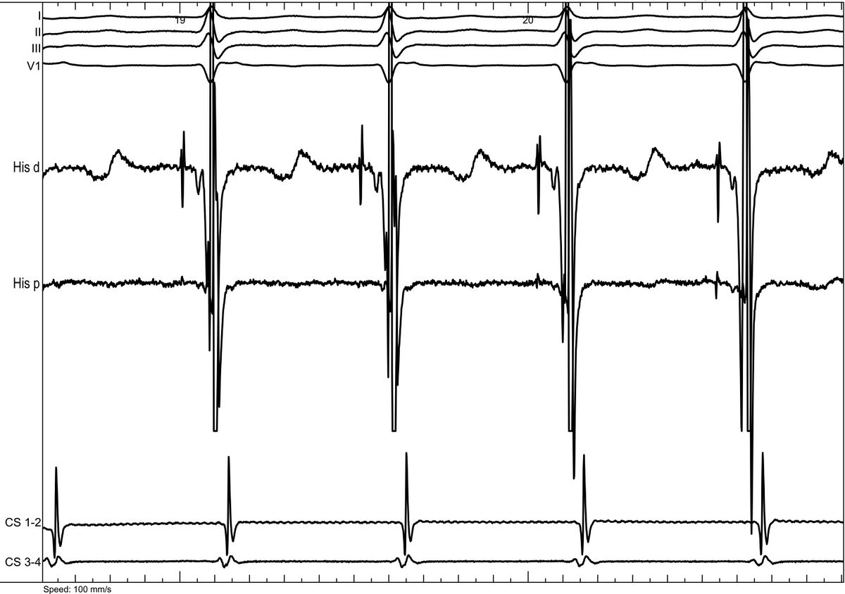 Tachycardie par réentrée intra-nodale — Uness Cardiologie