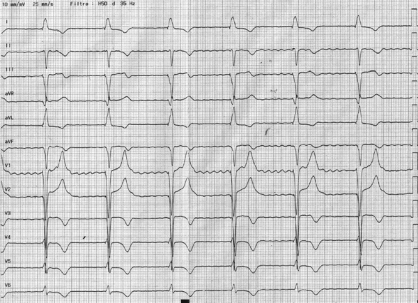 Complexe électro-entrainé — Uness Cardiologie