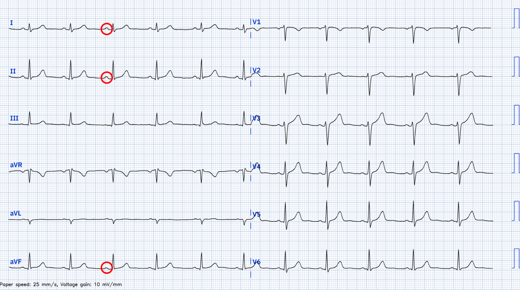 Electrocardiogramme normal — Uness Cardiologie